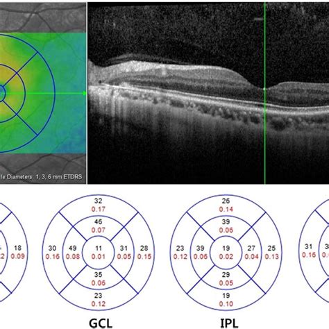 Macular Structural Segmentation Image Using Spectralis Sd Oct The Download Scientific Diagram