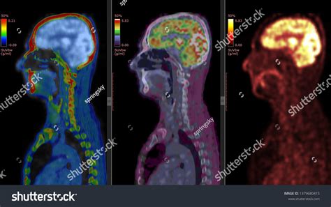 Positron Emission Tomography Brain