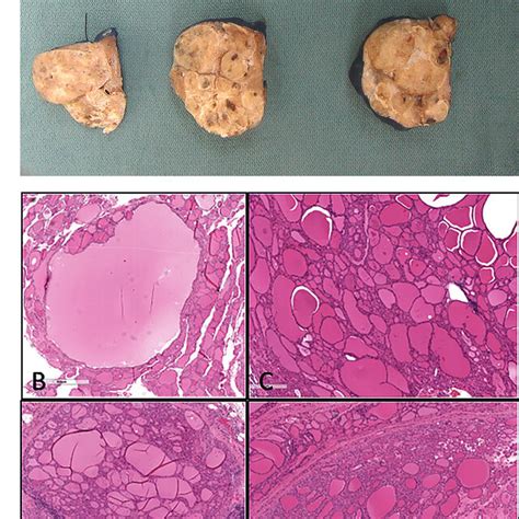 Overview Of The 2022 Who Classification Of Thyroid Neoplasms Request Pdf