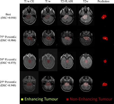 Segmentation Of Pediatric Brain Tumors Using A Radiologically Informed Deep Learning Cascade