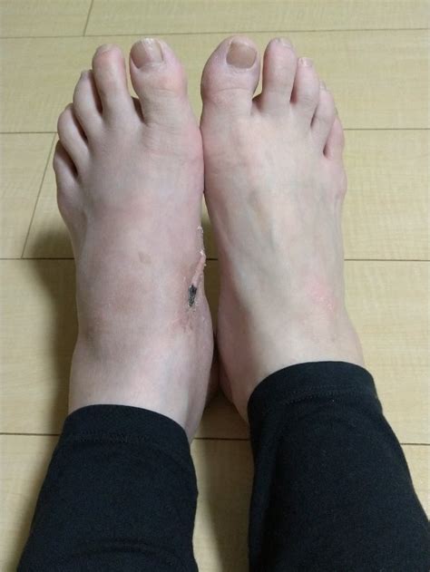 滑液包炎、その後 日々の事