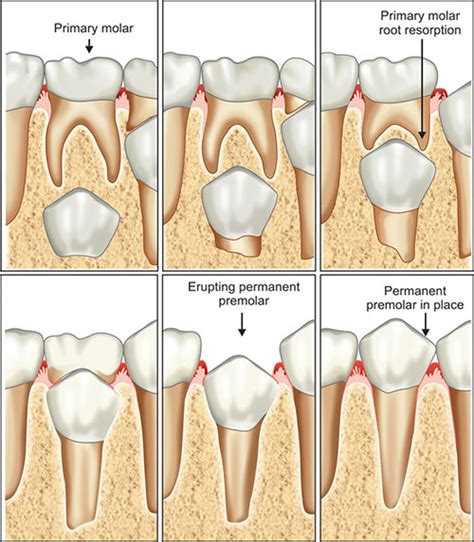 External Resorption Vs Internal Resorption