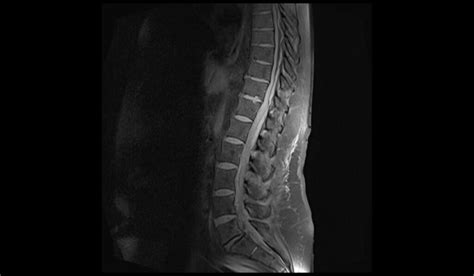 Spinal Epidural Hematoma Mri Radiology Article On Spinal Epidural