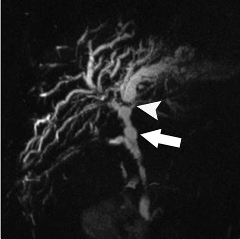 Sclerosing Cholangitis