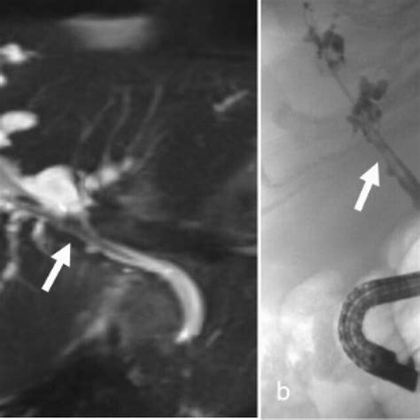 Magnetic Resonance Cholangiopancreatography Mrcp Maximum Intensity Download Scientific