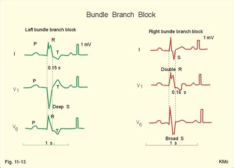 Right Vs Left Bundle Branch Block Ecg
