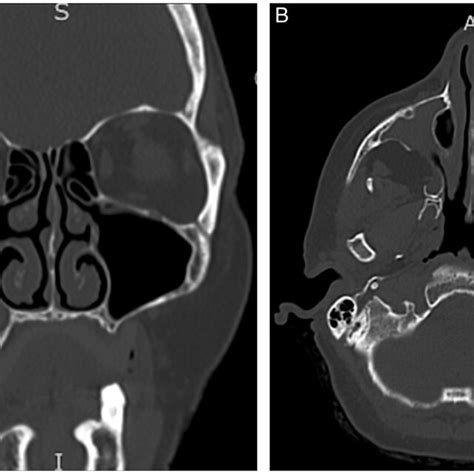 Complete Opacification Of The Left Maxillary Sinus Likely Due To Download Scientific Diagram