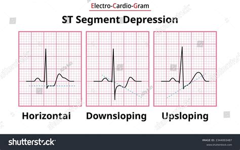 St Segment Depression