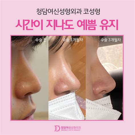 청담여신성형외과 코성형 입술성형 윤곽성형 눈성형 💜청담여신💜 Deesse Before And After [입술성형] [입꼬리