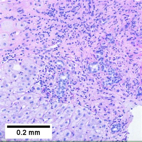 Focal Nodular Hyperplasia Libre Pathology