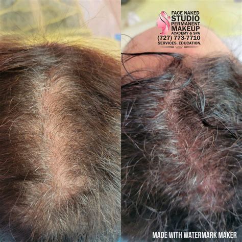 Scalp And Beard Micropigmentation Face Naked Studio