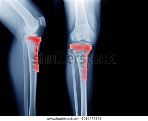 X Ray Image Fracture Tibia Bone Internal Stock Photo Shutterstock