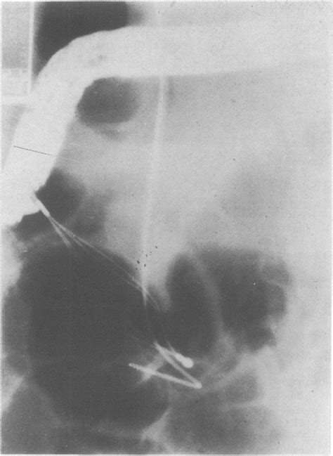 Final Antegrade Cholangiography In This Case Via A Cholecystostomy