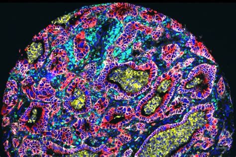 Ai Tool Capable Of Classifying Brain Tumors Within Hours