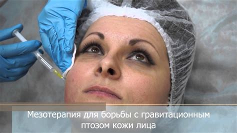 Мезотерапия лица для борьбы с морщинами Youtube