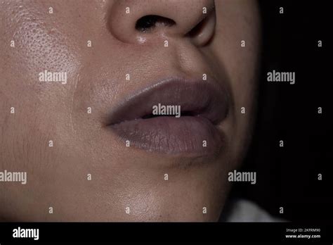Central Cyanosis In The Lips Of Southeast Asian Young Man With
