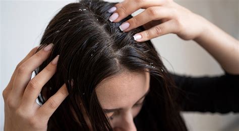 Understanding Dandruff Causes And Symptoms Shree Sai Clinic
