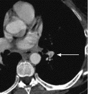 Pulmonary Embolism In Segmental And Subsegmental Arteries Optimal Technique Imaging