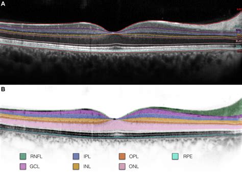 Normative Data For Retinal Layer Thickness Maps Generated By Spectral Domain OCT In A White