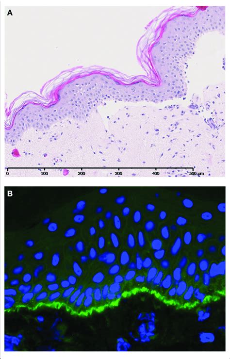 A Case Of Bullous Pemphigoid Histology Shows A Subepidermal Blister