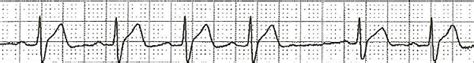 Sinoatrial SA Exit Block ECG Review Criteria And Examples LearntheHeart Com