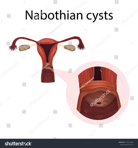Nabothian Cysts Cervical Disease Medical Anatomy Stock Illustration 1578513382 Shutterstock