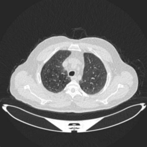 5 Effect Of Applying Gaussian Blur Filter On The Lung Cancer Samples