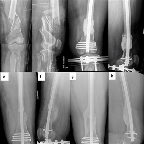 Pdf Bone Repair Using The Masquelet Technique