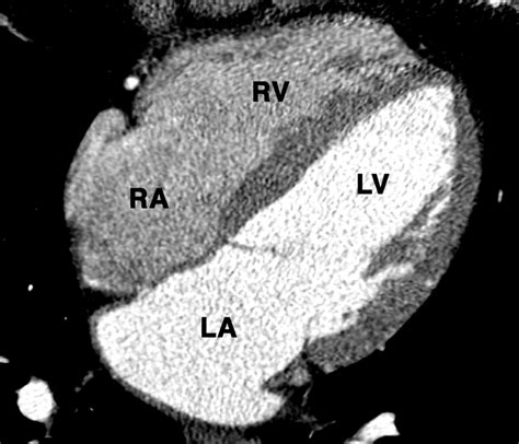 Ecg Gated Cardiac Ct Ajr