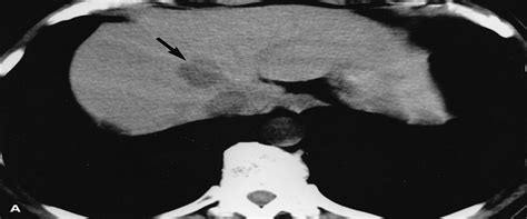 Cholangiolocellular Carcinoma Of The Liver Ct And Mr Findin Journal Of Computer Assisted