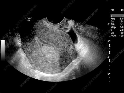 Endometrial Polyp Ultrasound Scan Stock Image C017 7800 Science Photo Library