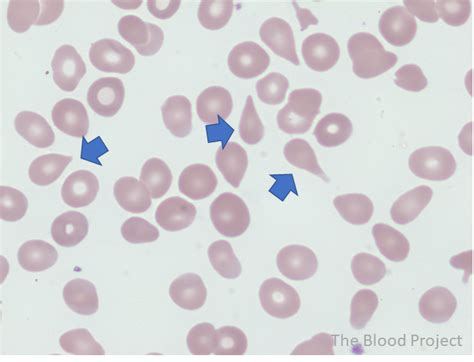 Teardrop Cells • The Blood Project