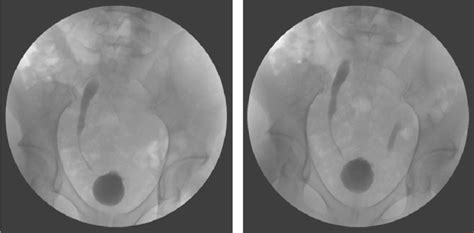 Bilateral Vesicoureteral Reflux By Voiding Cystourethrogram Download