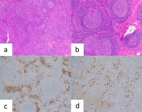 Cervical Lymph Node Histopathology Multicentric Mixed Type Castleman