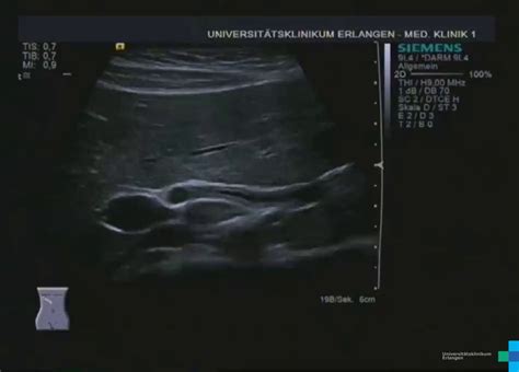Cholangitis Ultraschall