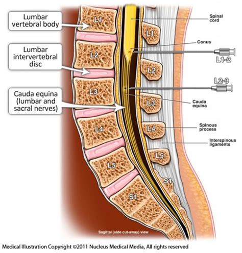 Myelogram Insideradiology