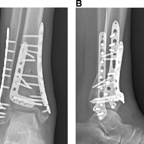 Pdf Efficacy Of Pie Crusting Technique On Soft Tissues In Distal Tibia And Fibula Fractures
