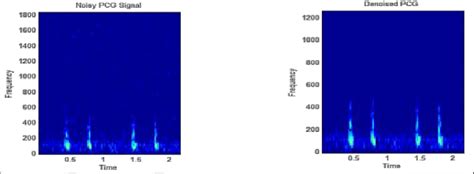 Spectrogram Of Noisy And Denoised Pcg Signal Time Domain Signal Pcg