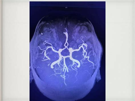 Cns Vasculitis Primary Vs Secondary Pptx