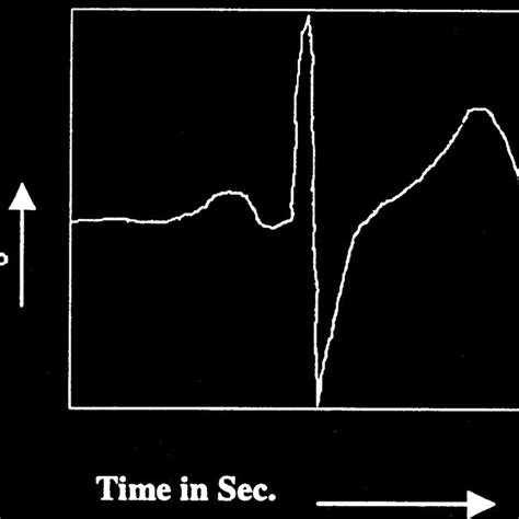 Image Of Original Ecg Signal From Chart Record Download Scientific
