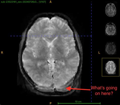Incorrect Qsiprep Preprocessed Image Software Support Neurostars