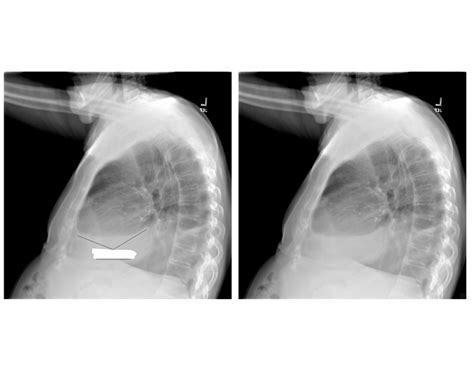 Cxr Atelectasis Quiz