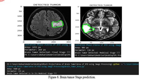 Enhanced Brain Tumor Detection And Stage Prediction Through A Unified CNN Based Framework