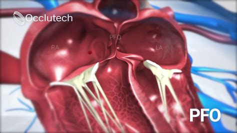 Occlutech Pfo Occluder Occlutech Every Beat Counts