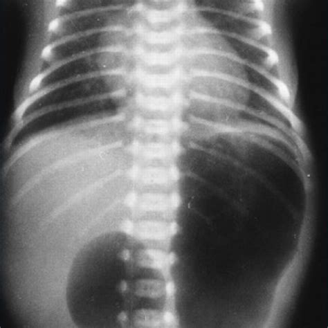 Types Of Intestinal Atresia According To The Grosfeld Classification Download Scientific
