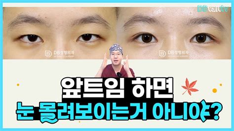 앞트임 하면 눈 몰려보이는거 아니야 Youtube