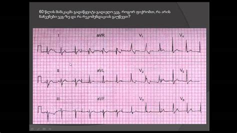 ეკგ ანალიზი შეუღლებული ბლოკადა ორკონოვანი ბლოკადა მარცხენა წინა ჰემიბლოკი Youtube