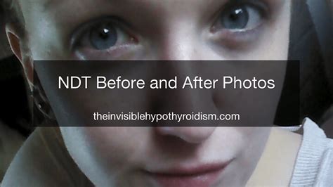 Hypothyroidism Before And After Face