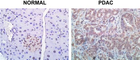 This Killer Protein Causes Pancreatic Cancer Cold Spring Harbor