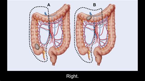 Cecum Cancer Surgery